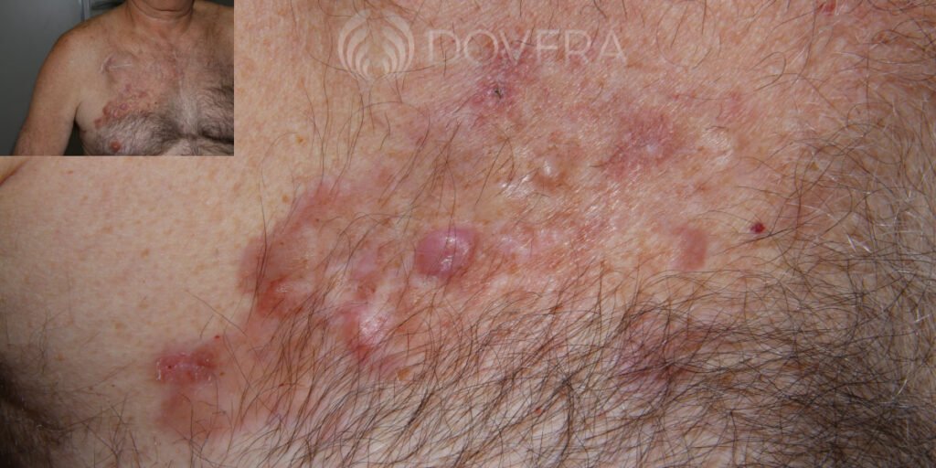 Dermatofibrosarcoma protuberans - Qual o melhor tratamento?