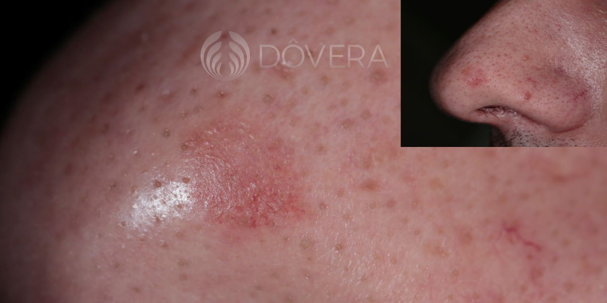 Queratose actínica - Diagnóstico e tratamento