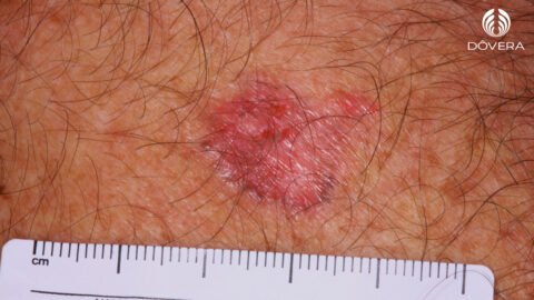 Carcinoma basocelular superficial - Diagnóstico e tratamento
