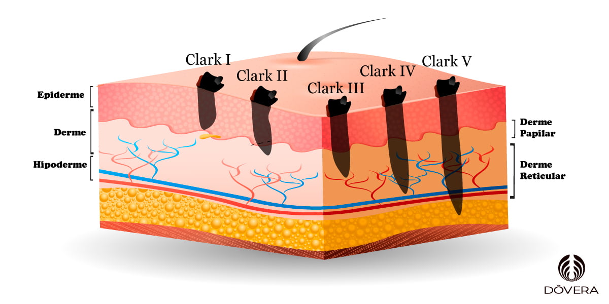 Como interpretar o resultado de biópsia de um melanoma