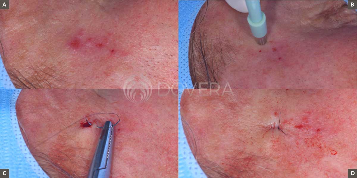 Biópsia de pele - como é feita