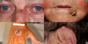 Carcinoma espinocelular - Diagnóstico e Tratamento