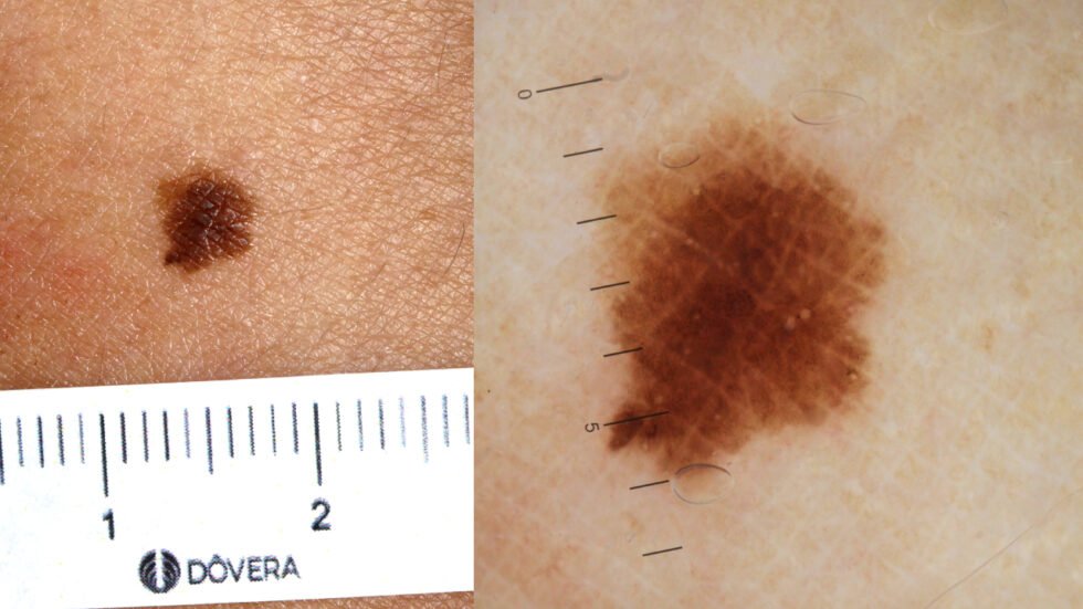 Dermatoscopia digital - como é feito