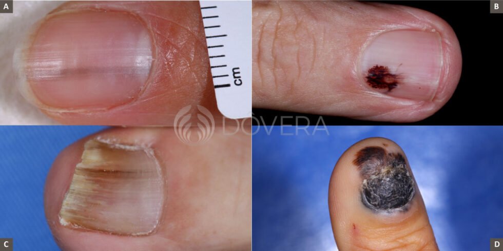 Mancha escura na unha - Quais os sinais de alerta