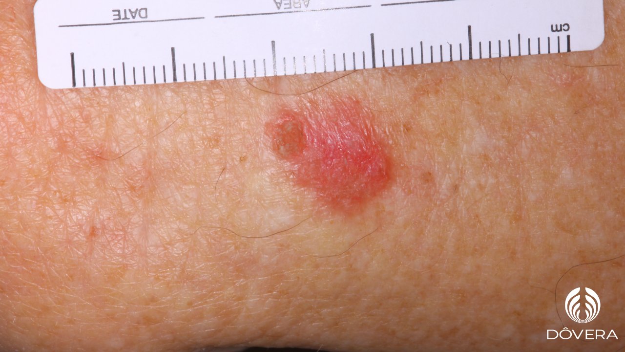 Doença de Bowen - Diagnóstico e tratamento