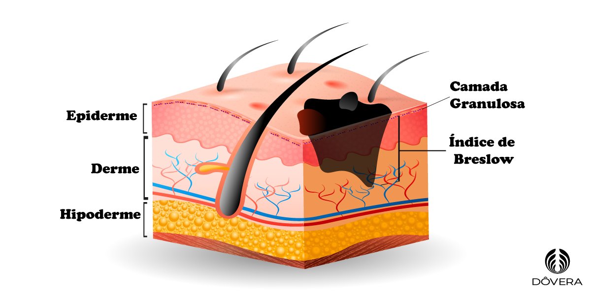 O que é índice de Breslow?