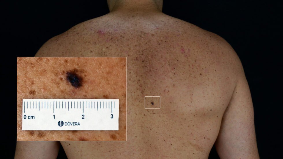 Melanoma Extensivo Superficial - Diagnóstico e Tratamento