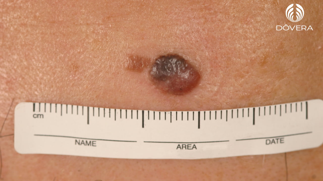 Melanoma Nodular -Diagnóstico e tratamento