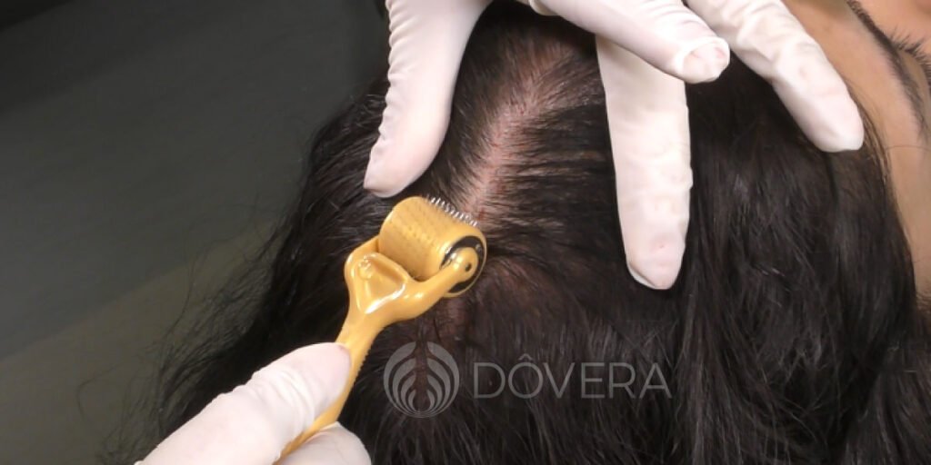 Microagulhamento capilar - Como é feito