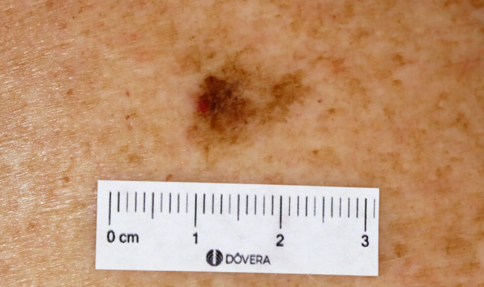 Melanoma in situ - Diagnóstico e tratamento