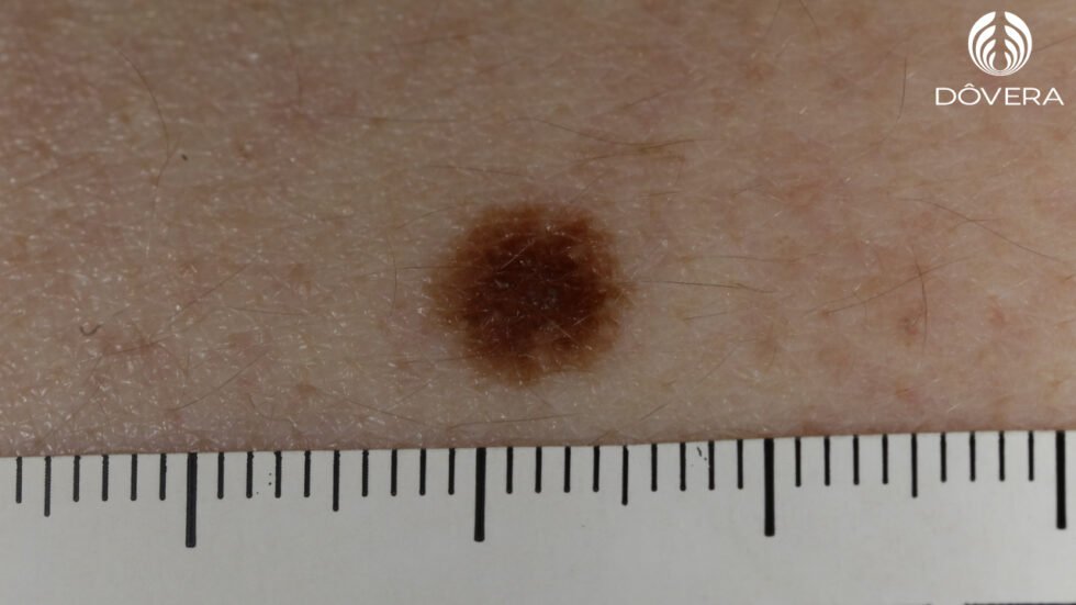 Pintas ou sinais benignos (nevo melanocítico)