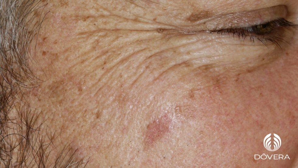 Queratose actínica - Diagnóstico e tratamento