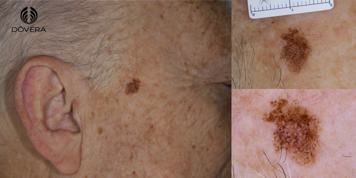 Lentigo Maligno Melanoma - Diagnóstico e Tratamento