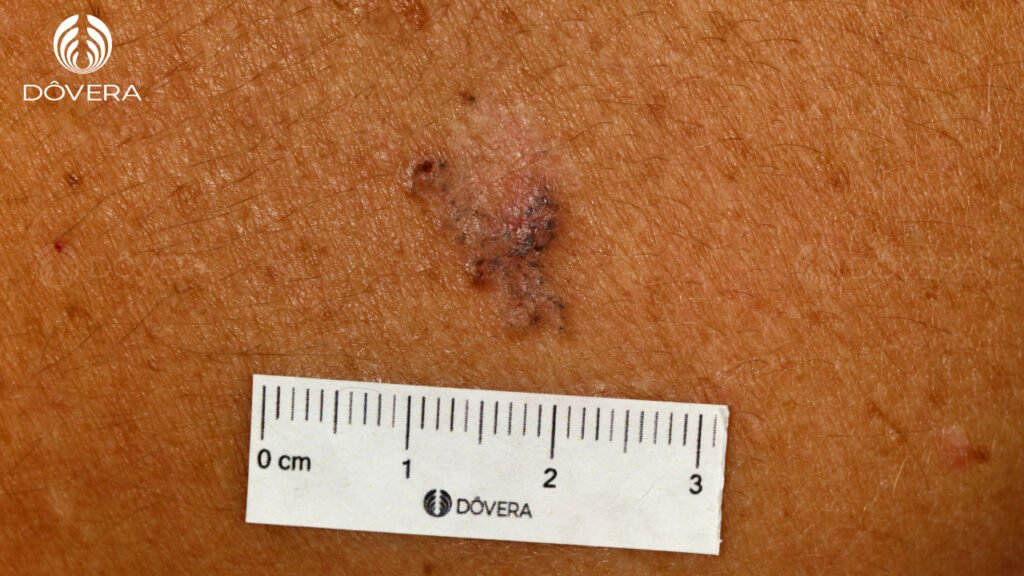 Fotos de carcinoma basocelular