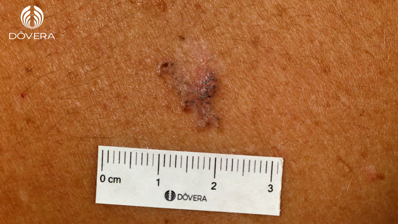 Fotos de carcinoma basocelular