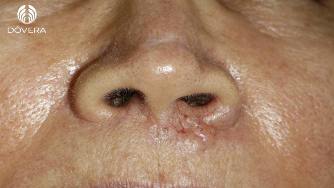 Fotos de carcinoma basocelular