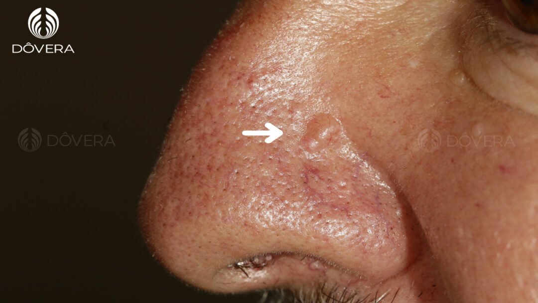 Fotos de carcinoma basocelular