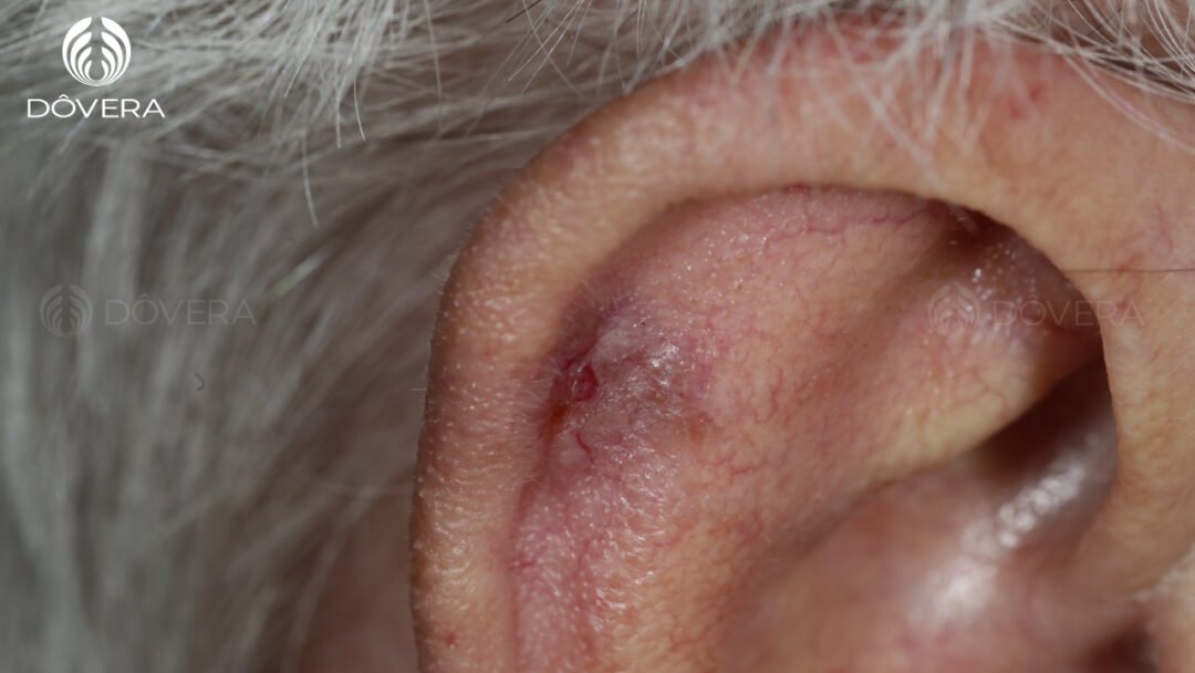 Fotos de carcinoma basocelular