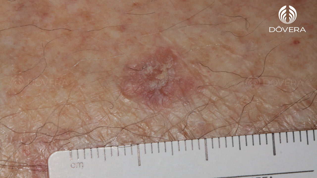 Grau de diferenciação do carcinoma espinocelular