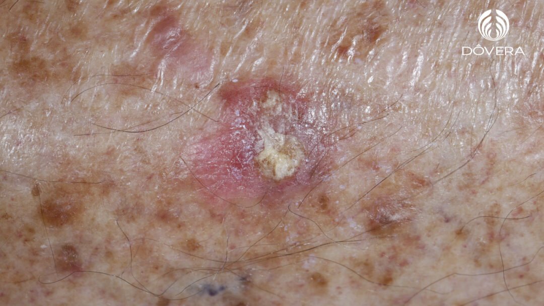 Grau de diferenciação do carcinoma espinocelular