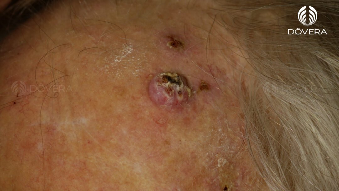 Grau de diferenciação do carcinoma espinocelular