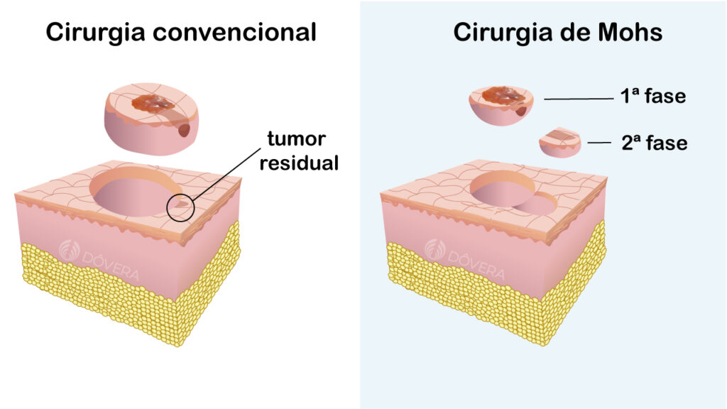 Cirurgia micrográfica de Mohs - Como é feita e indicações