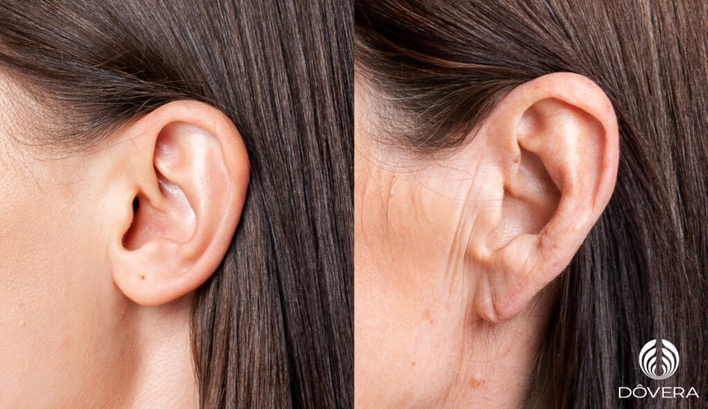 Rejuvenescimento de lóbulo de orelha