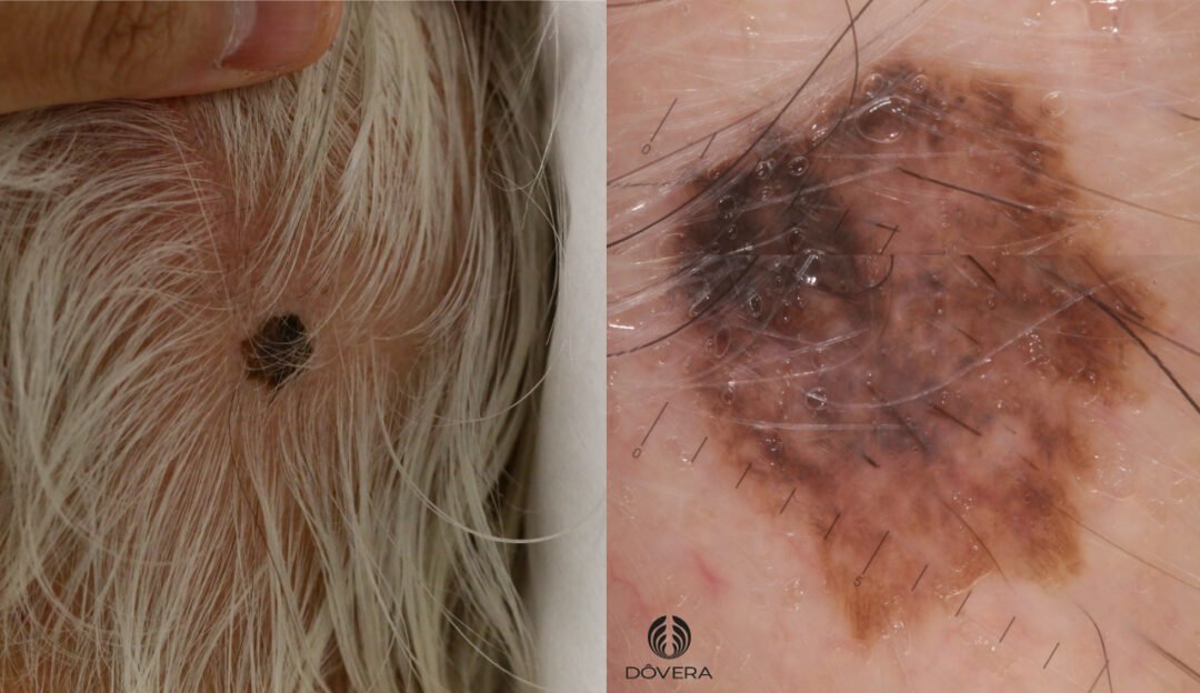 Melanoma de couro cabeludo - diagnóstico e tratamento