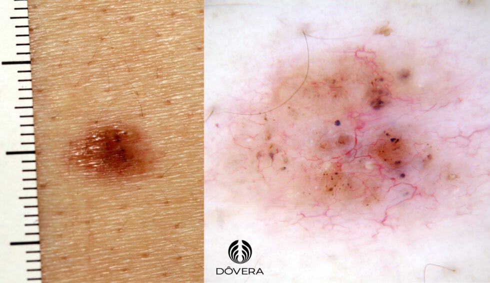 Dúvidas mais comuns sobre carcinoma basocelular