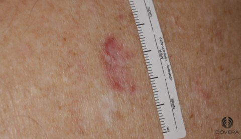 Carcinoma basocelular: guia completo
