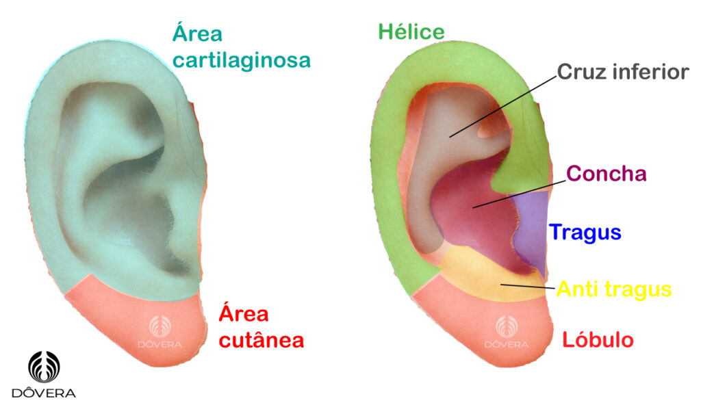 Queloide na orelha: como tratar?