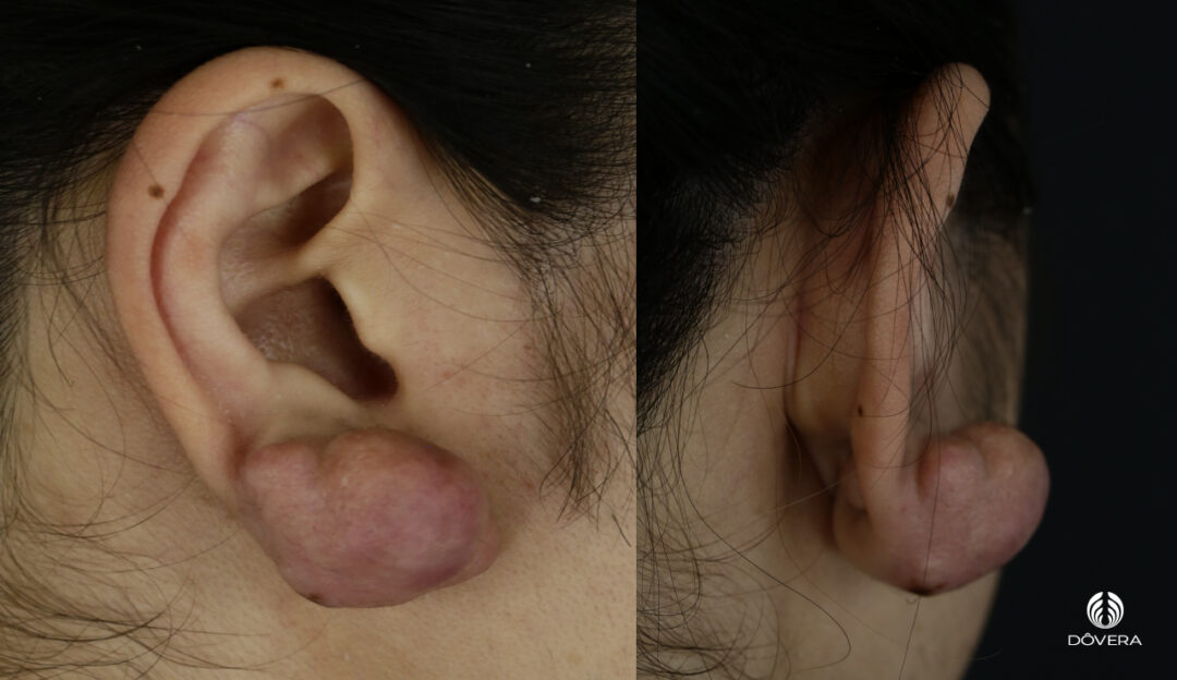 Queloide na orelha: como tratar?