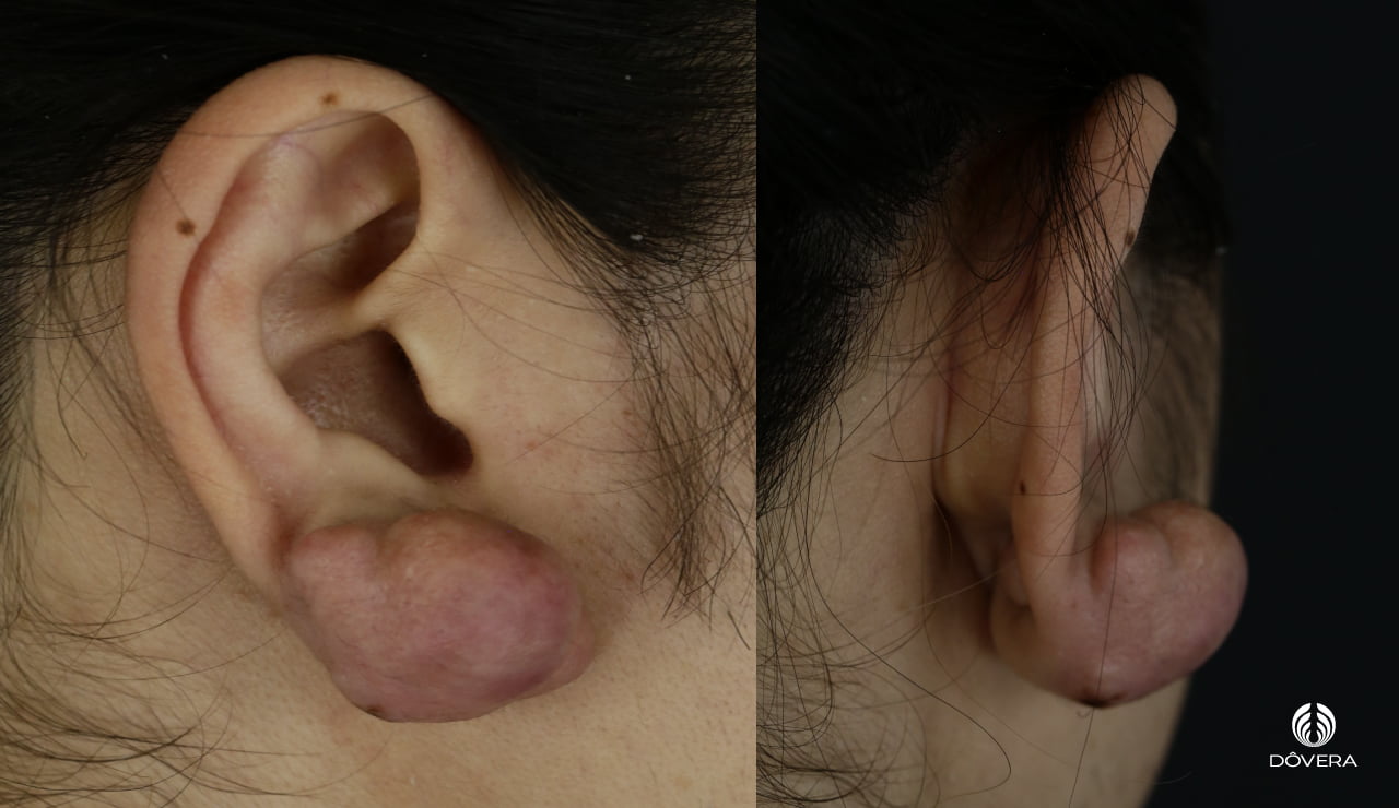 Queloide na orelha: como tratar?